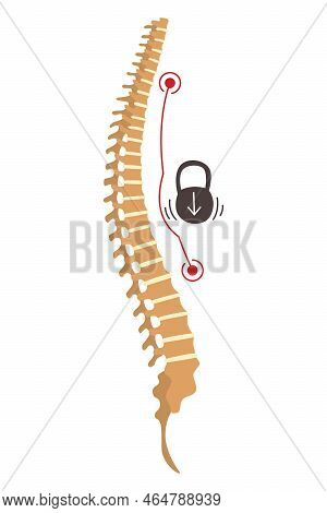 Spinal Deformity Vector Photo Free Trial Bigstock