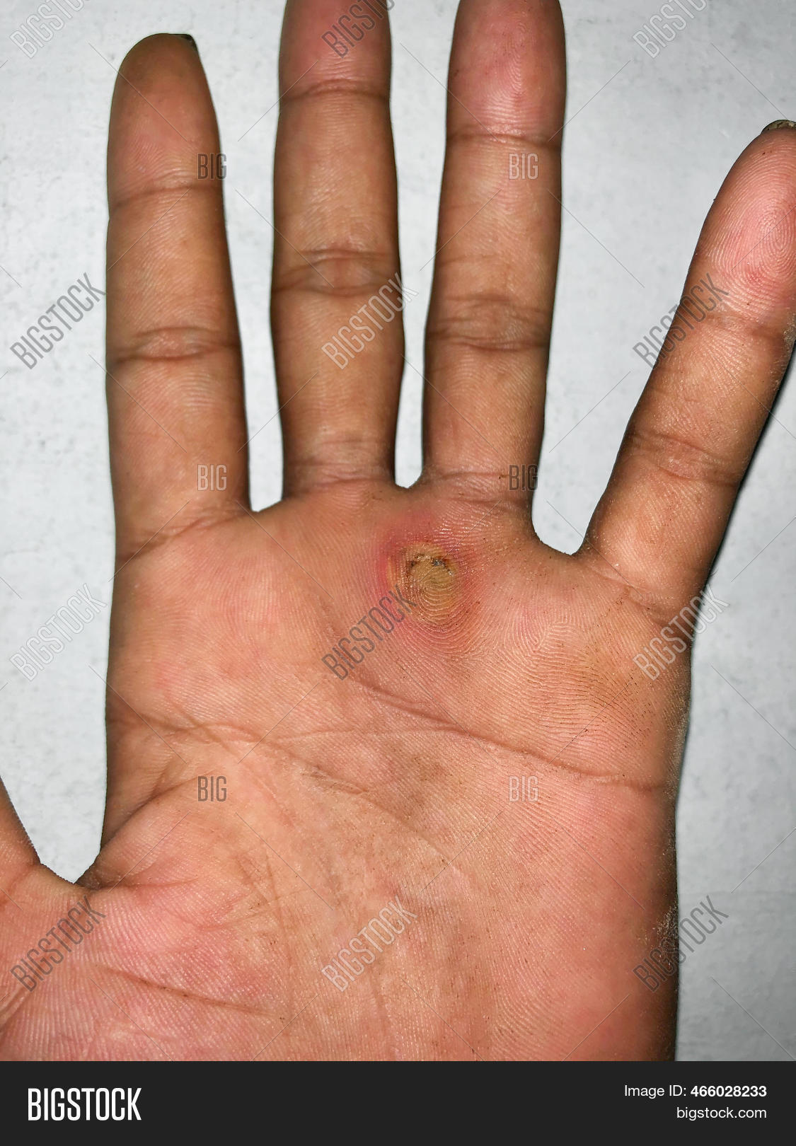 Cellulitis Hand