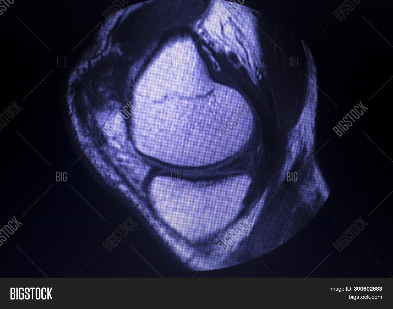 Mri Knee Meniscus Tear Image & Photo (Free Trial) | Bigstock