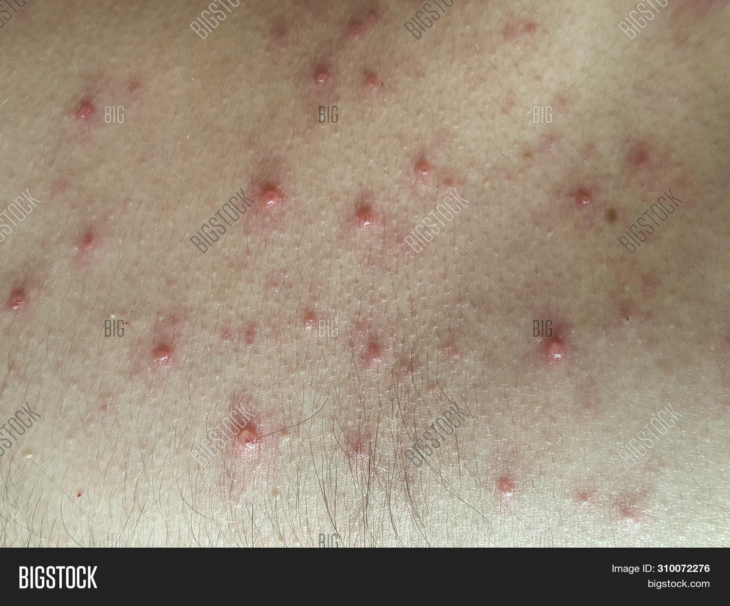 Chicken Pox Rash On Image & Photo (Free Trial) | Bigstock