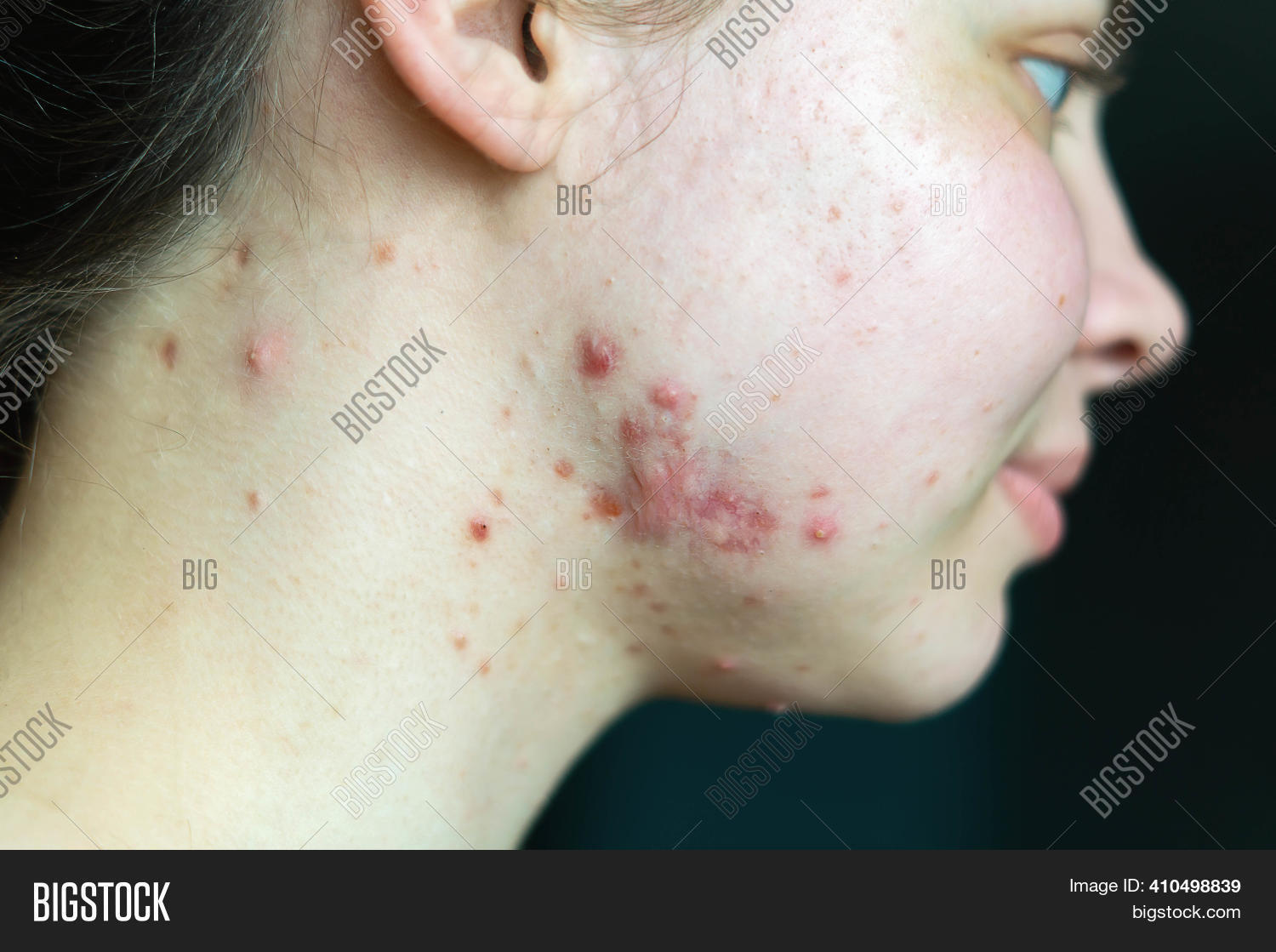 Pimples On Skin Young Image & Photo (Free Trial) | Bigstock