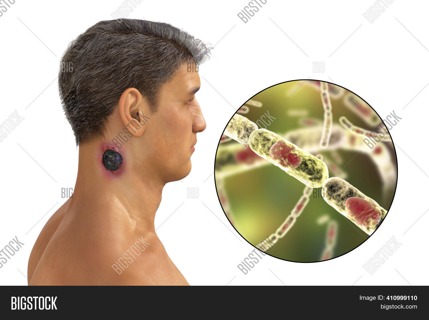 Cutaneous Anthrax, Image & Photo (Free Trial) | Bigstock