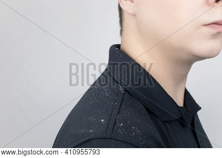 Dandruff On Man's Image & Photo (Free Trial) | Bigstock