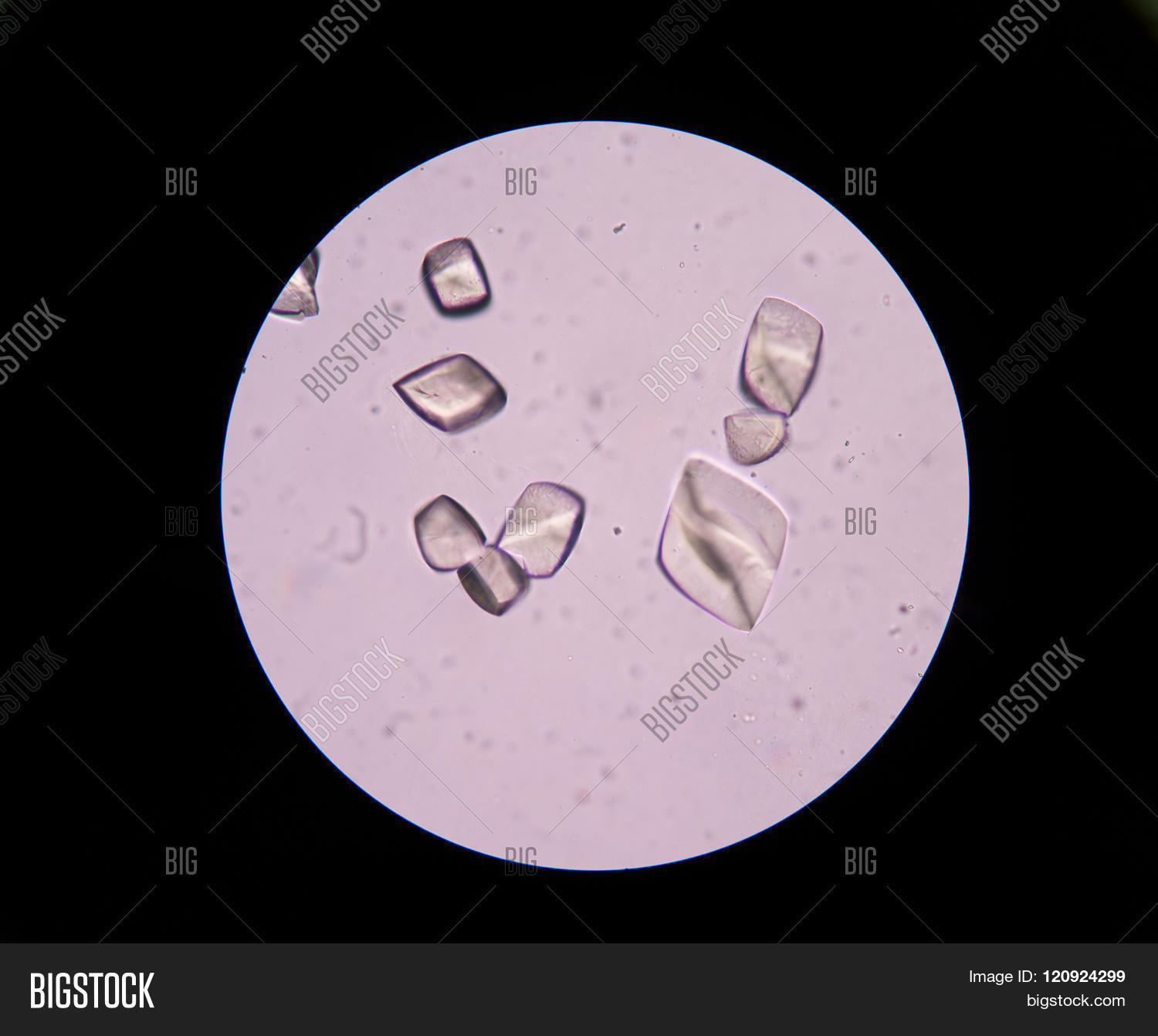 Uric Acid Crystal Image & Photo (Free Trial) | Bigstock