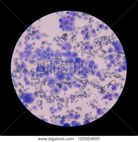 Malignant Cells Image & Photo (Free Trial) | Bigstock