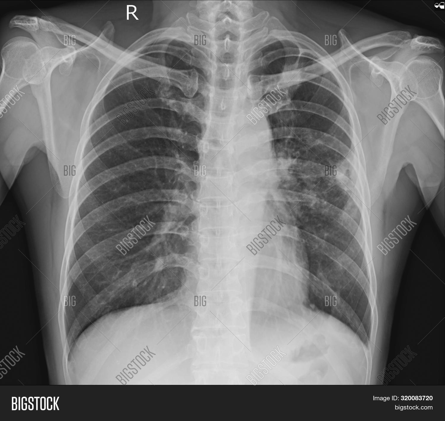 Pacemaker X-ray Image Image & Photo (Free Trial) | Bigstock