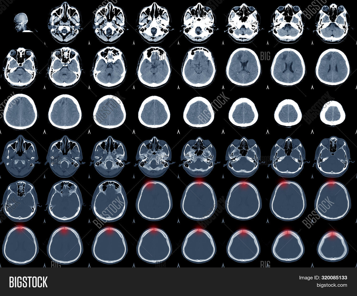 Ct Scan Brain Male 38 Image & Photo (Free Trial) | Bigstock