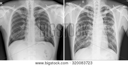 Pacemaker X-ray Image Image & Photo (Free Trial) | Bigstock