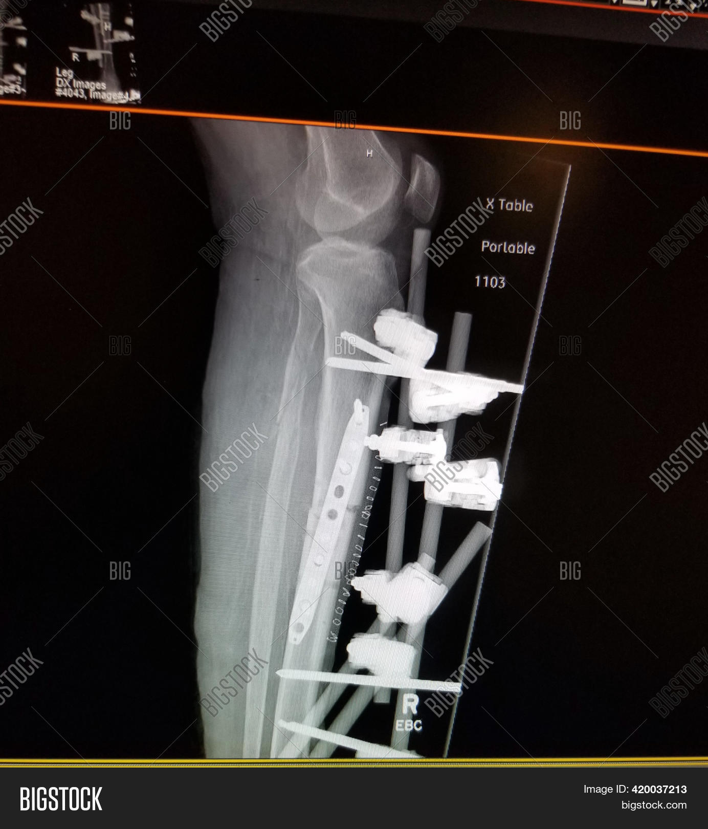 Right Tibial Fracture Image & Photo (Free Trial) | Bigstock