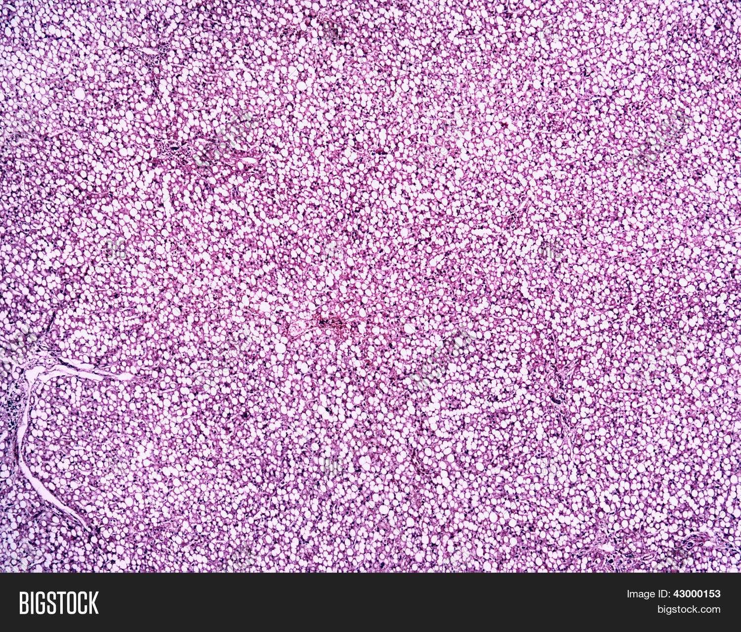 Liver Fatty Hepatosis Image & Photo (Free Trial) | Bigstock