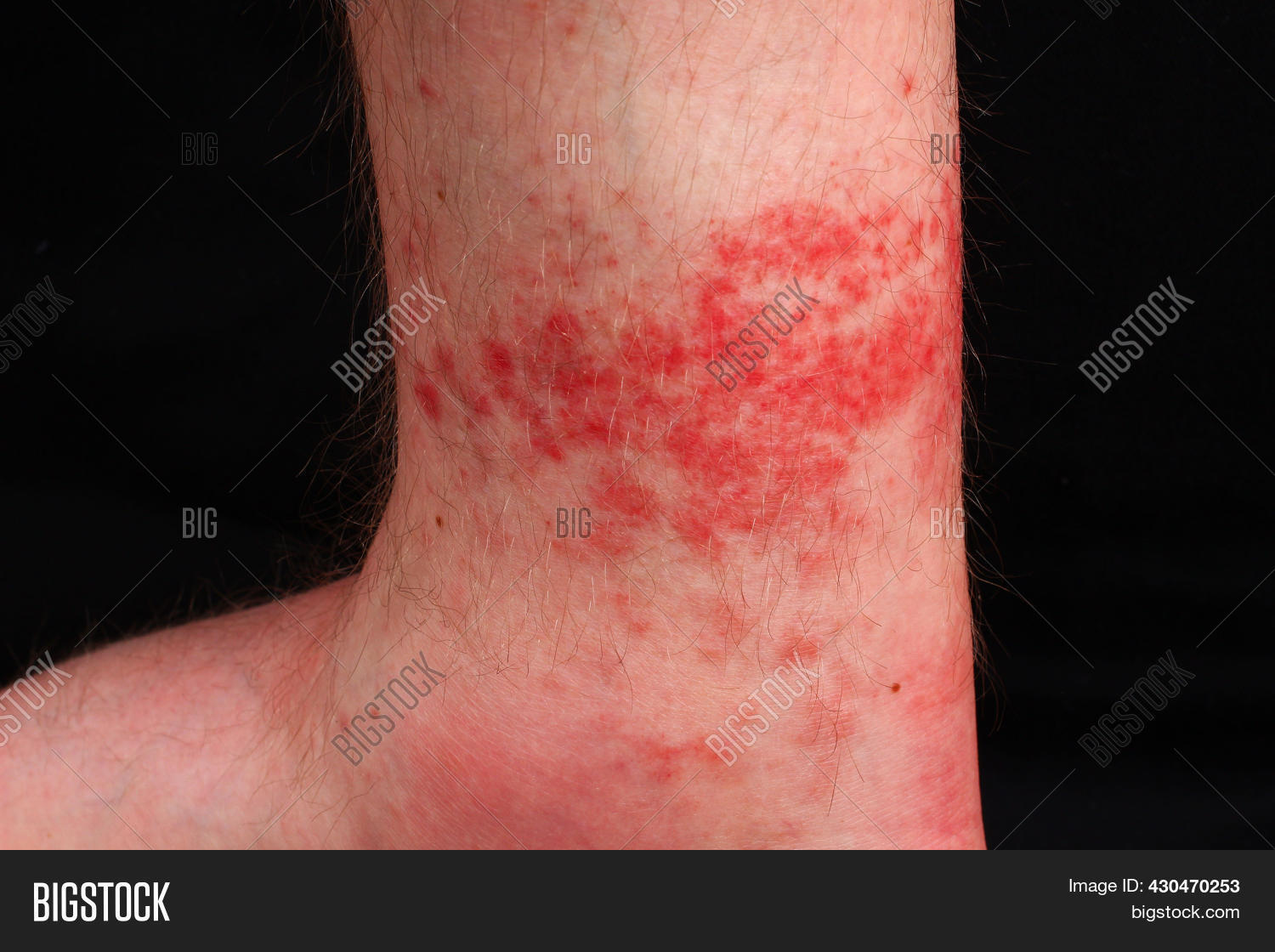 Leg After Bite Bee. Image & Photo (Free Trial) | Bigstock