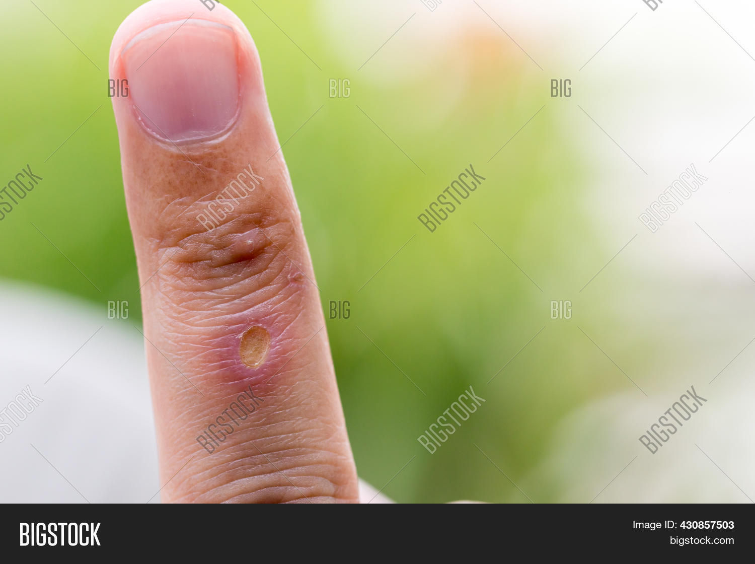 Paronychia, Swollen Image & Photo (Free Trial) | Bigstock