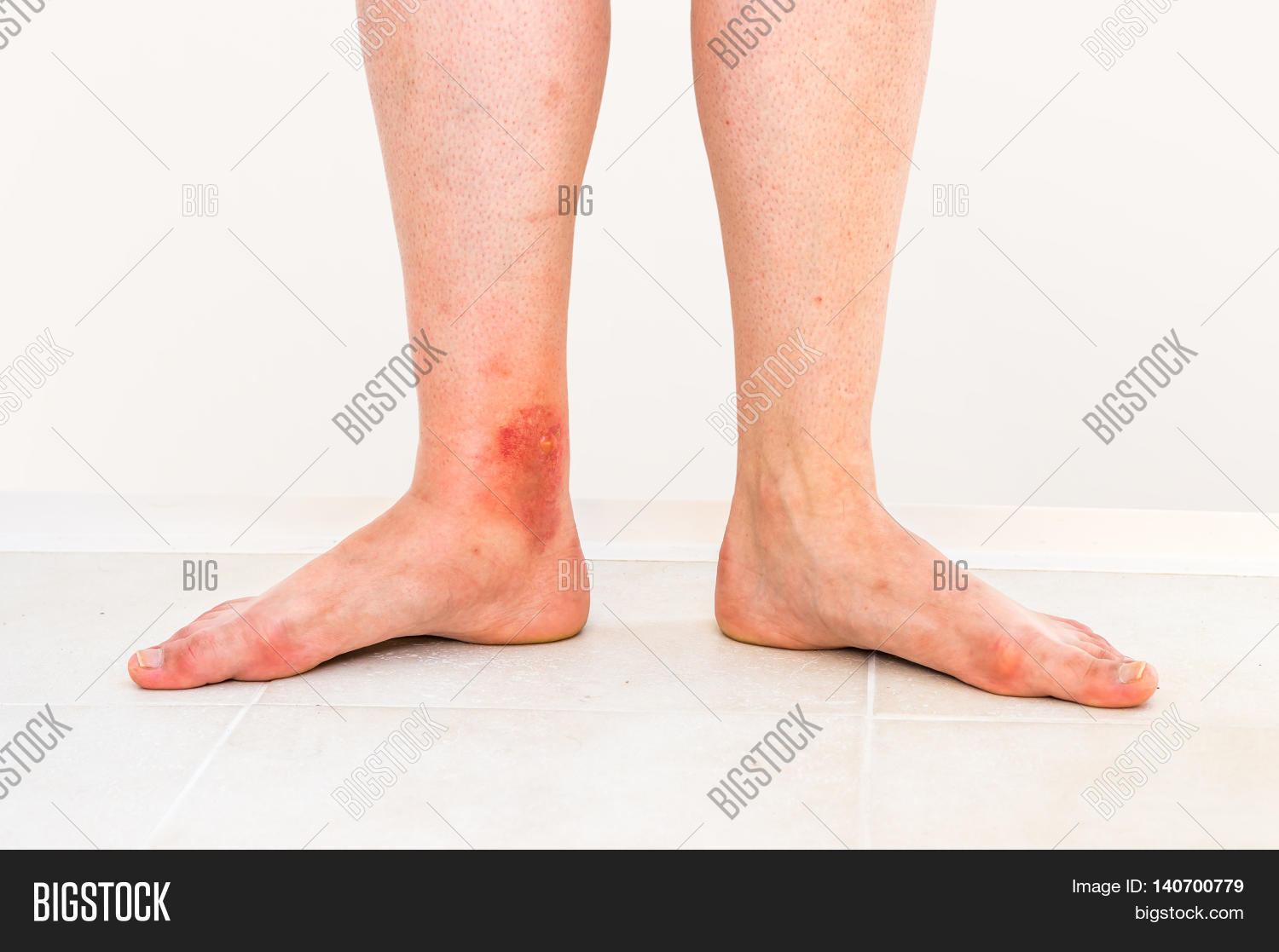Red Rash On Leg Image & Photo (Free Trial) | Bigstock