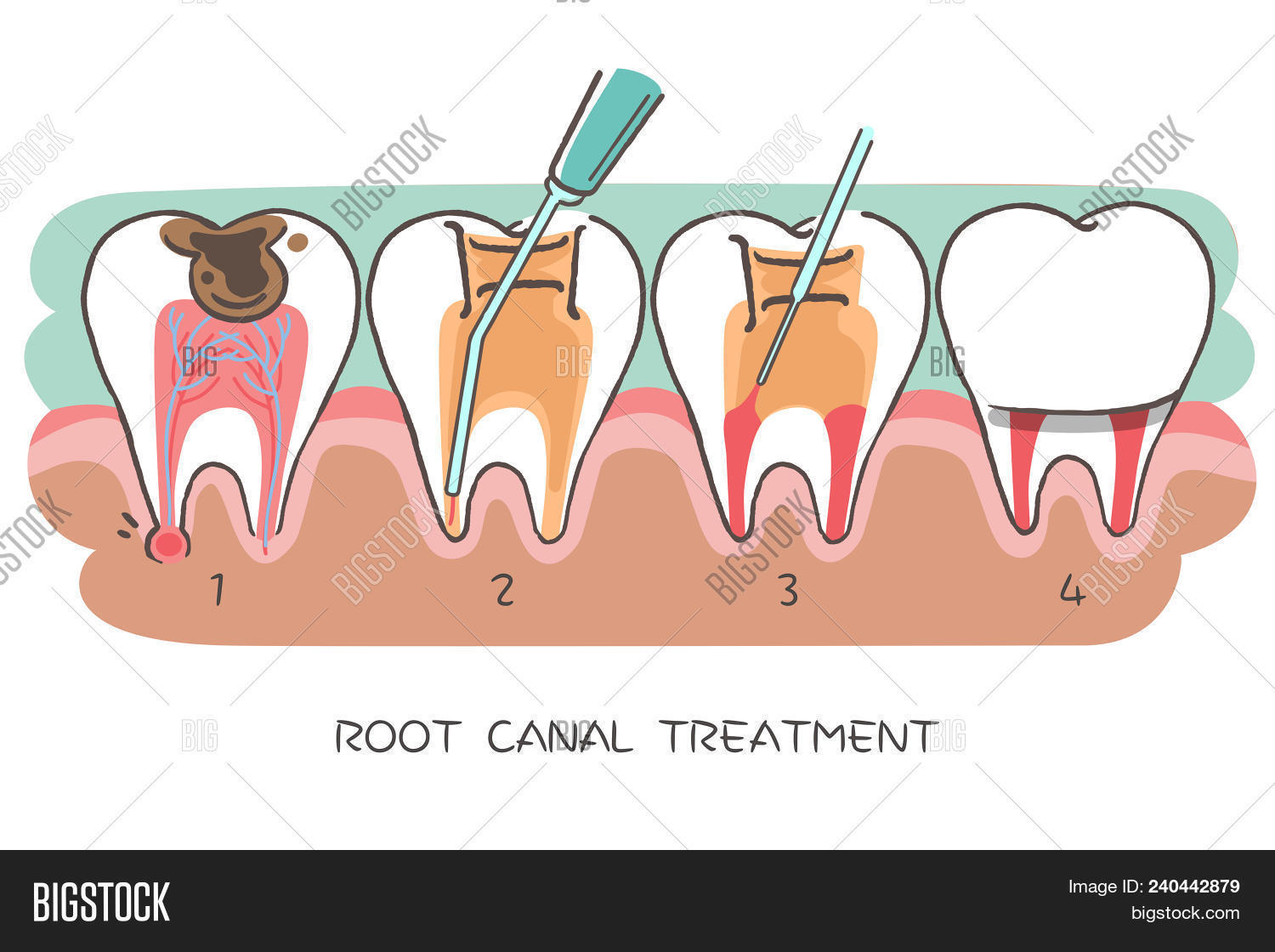 Tooth Root Canal Vector & Photo (Free Trial) | Bigstock