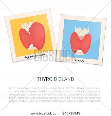 Hyperthyroid Healthy Vector & Photo (Free Trial) | Bigstock