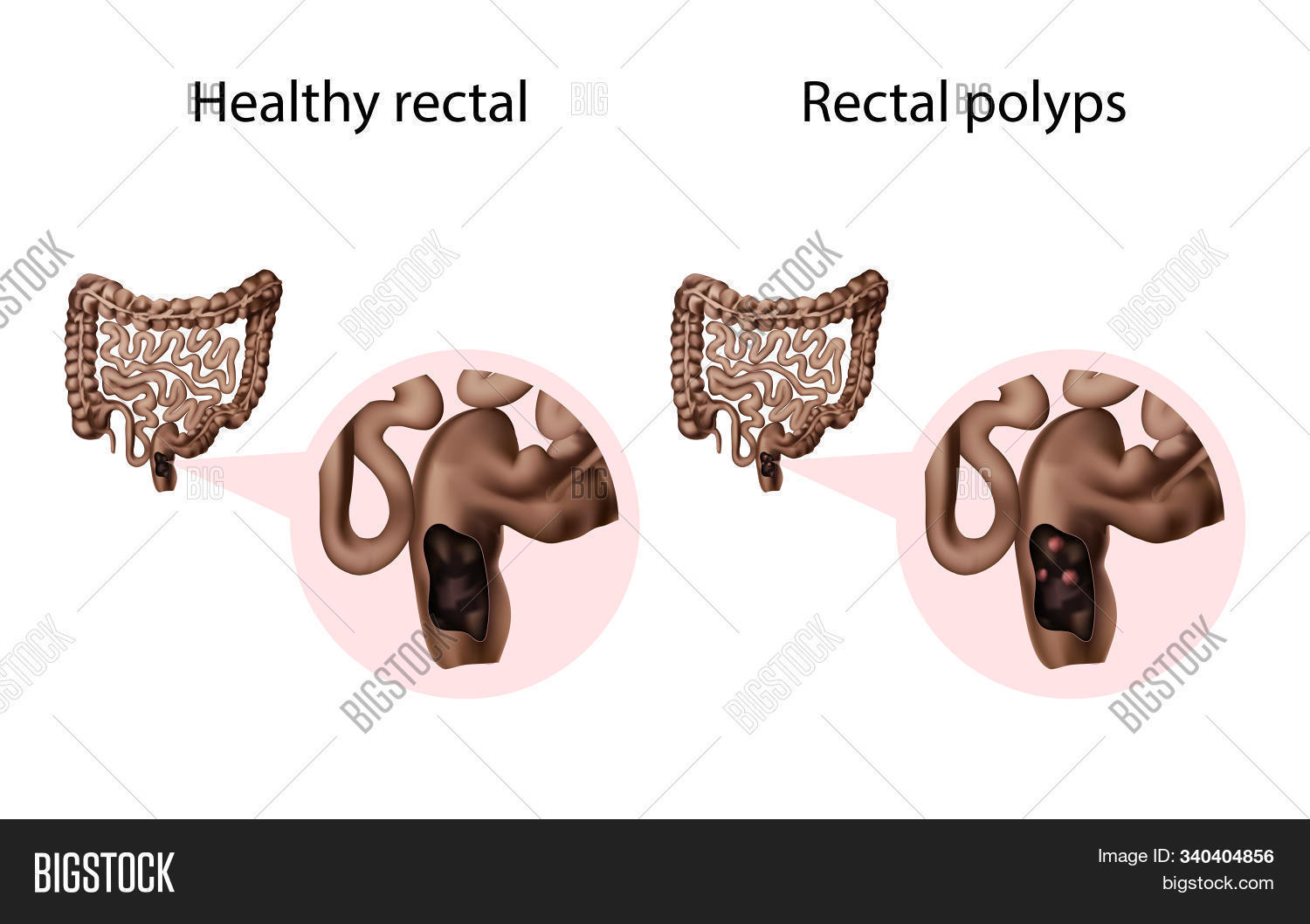 Rectal Polyps Healthy Image & Photo (Free Trial) | Bigstock