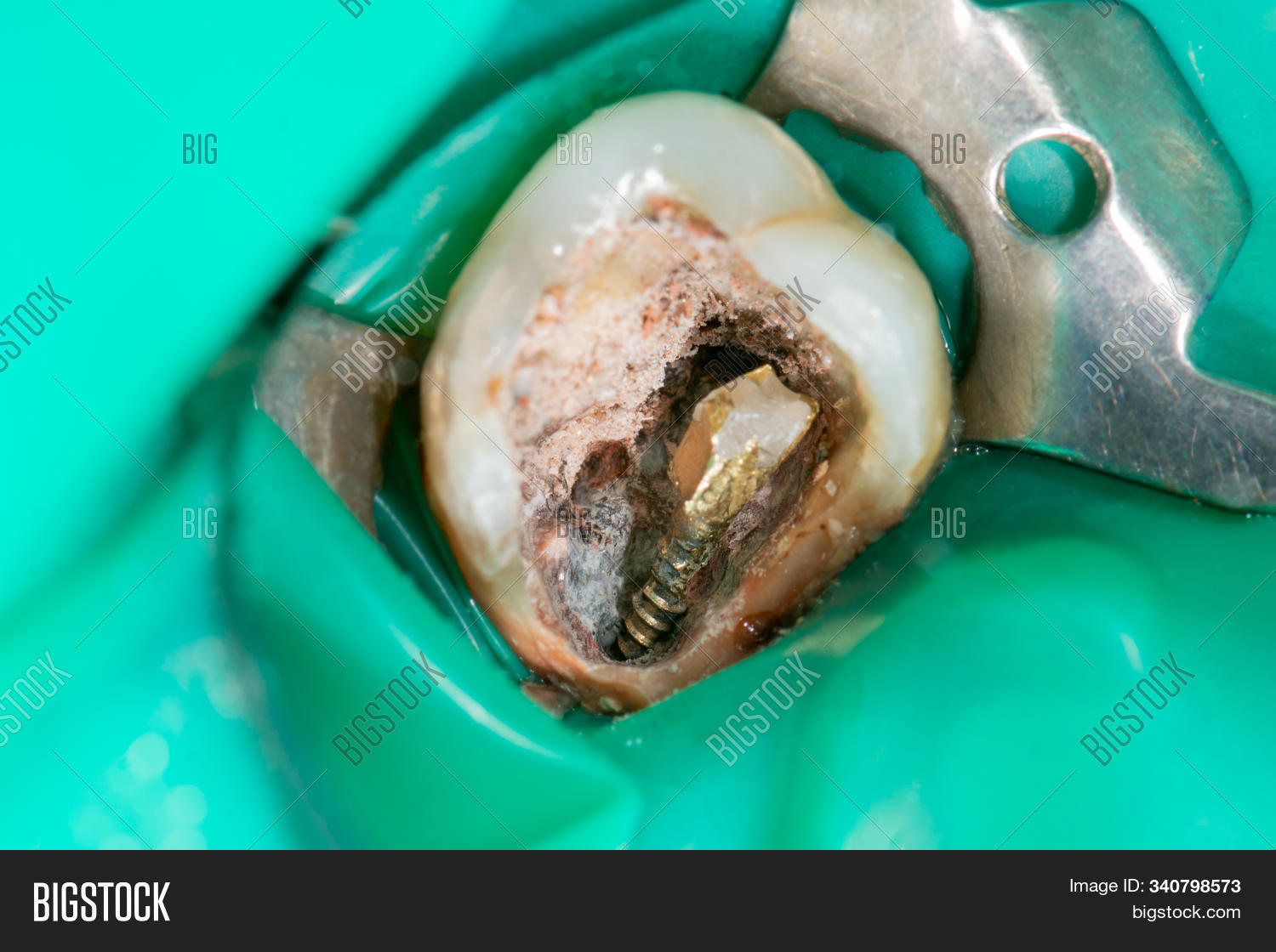 Human Tooth Close- Image & Photo (Free Trial) | Bigstock