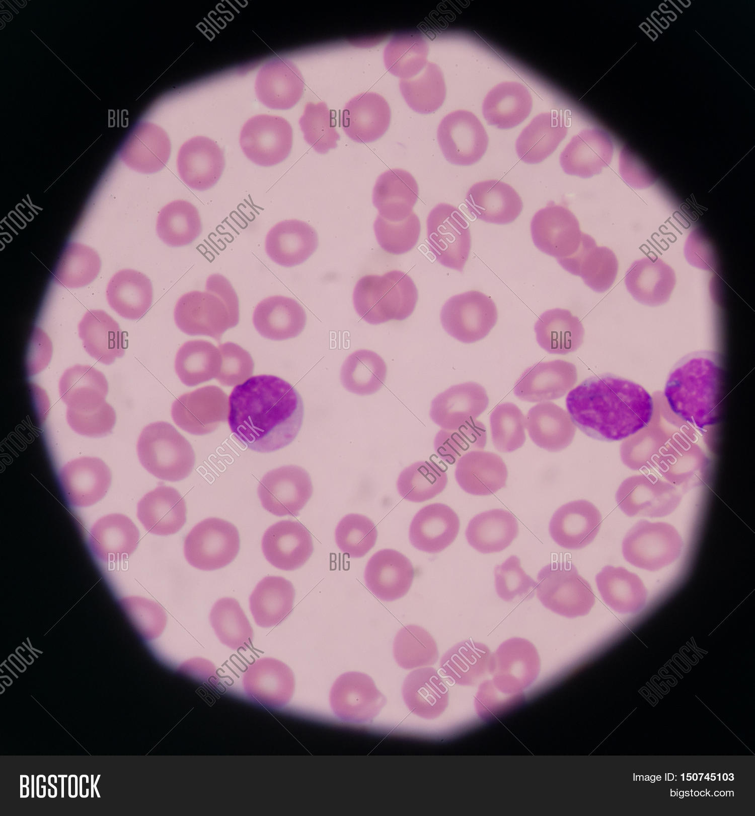 Blast Cells Peripheral Image & Photo (Free Trial) | Bigstock