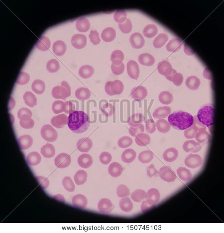 Blast Cells Peripheral Image & Photo (Free Trial) | Bigstock