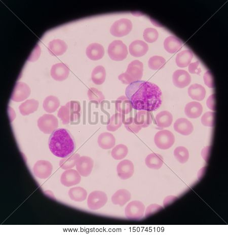 Blast Cells Peripheral Image & Photo (Free Trial) | Bigstock