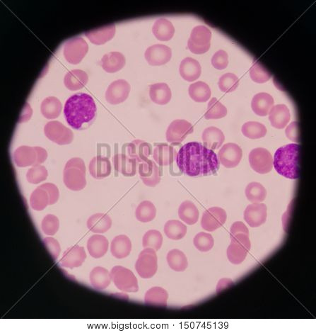 Blast Cells Peripheral Image & Photo (Free Trial) | Bigstock