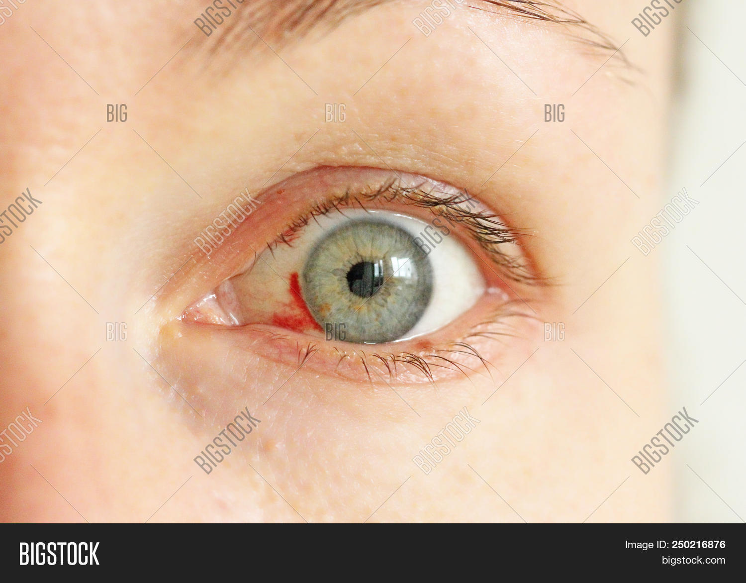 Bloodshot Eye. Woman Image & Photo (Free Trial) | Bigstock