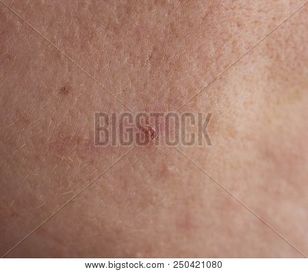 Red Pimple On Face Image & Photo (Free Trial) | Bigstock