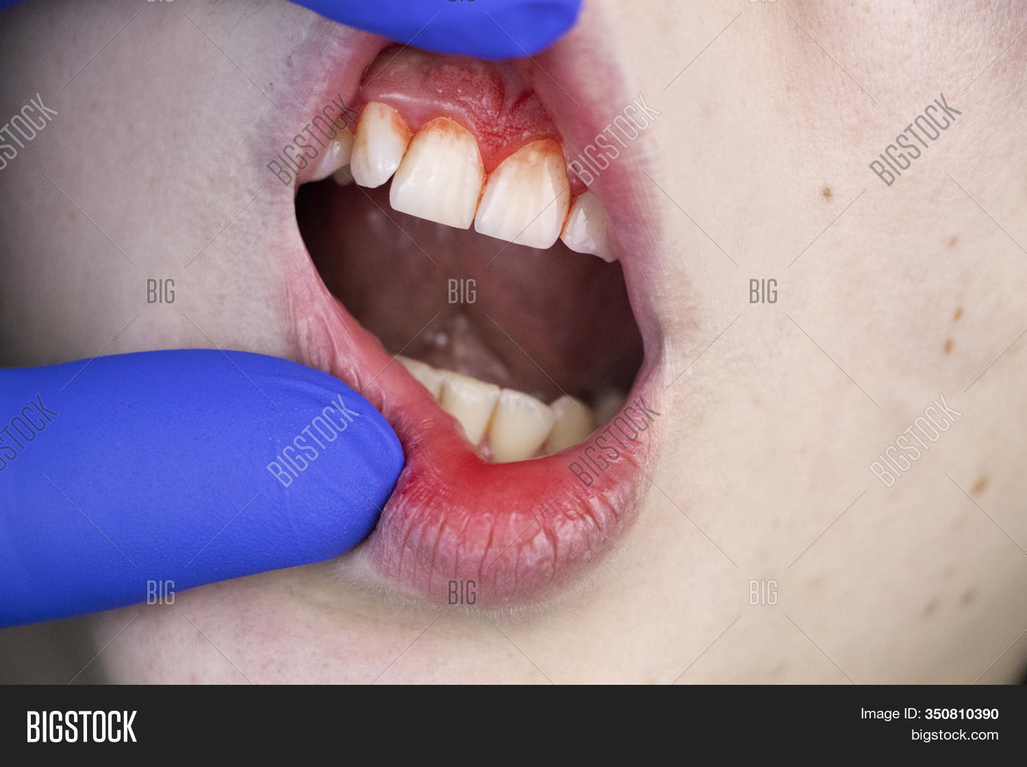 Gum Bleeding Image & Photo (Free Trial) | Bigstock
