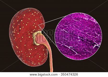 Acute Pyelonephritis, Image & Photo (Free Trial) | Bigstock