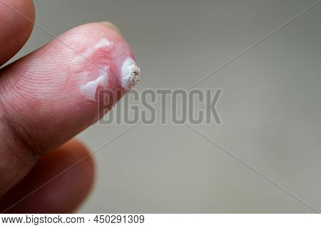 Closeup White Warts Image & Photo (Free Trial) | Bigstock