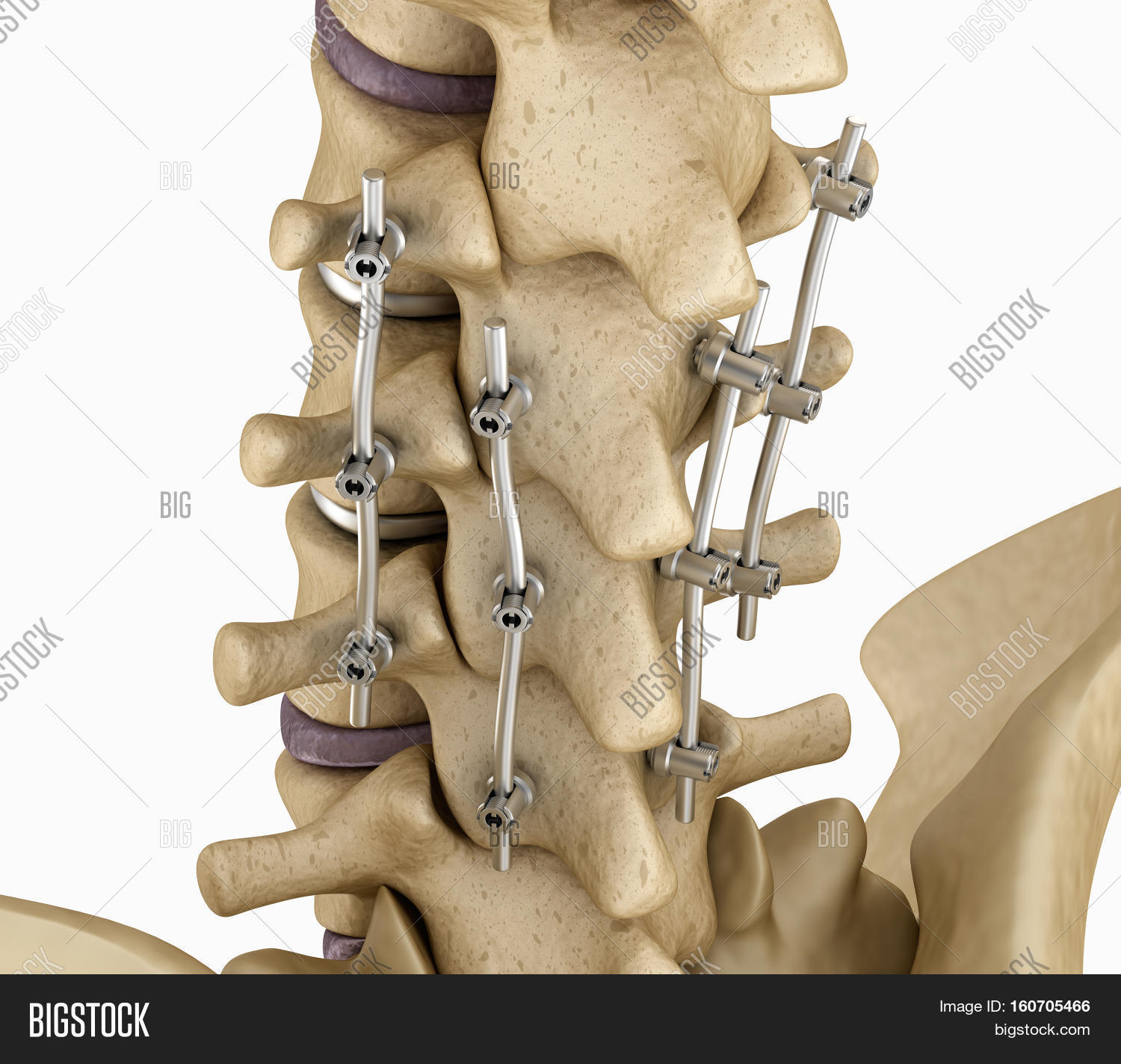 Spinal Fixation System Image & Photo (Free Trial) | Bigstock