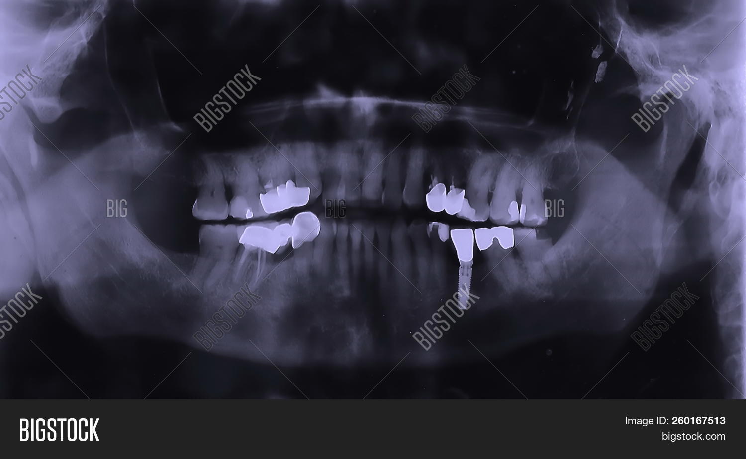 Original X-ray Teeth Image & Photo (Free Trial) | Bigstock