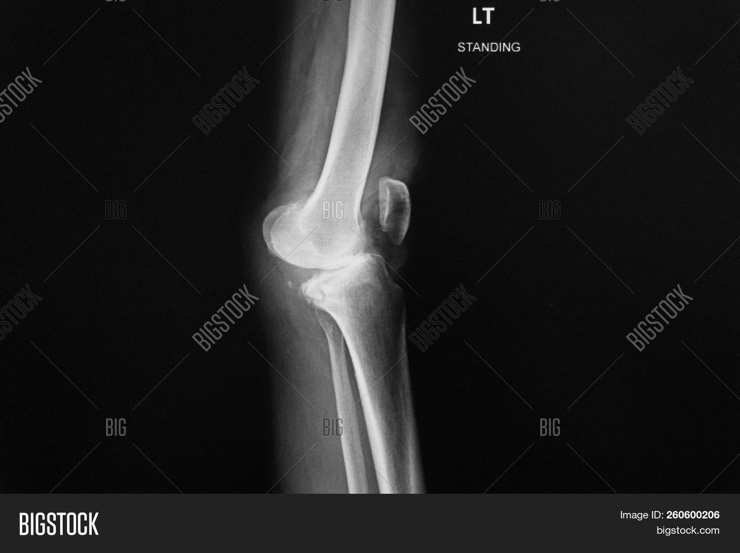X-ray Left Knee Joint Image & Photo (Free Trial) | Bigstock