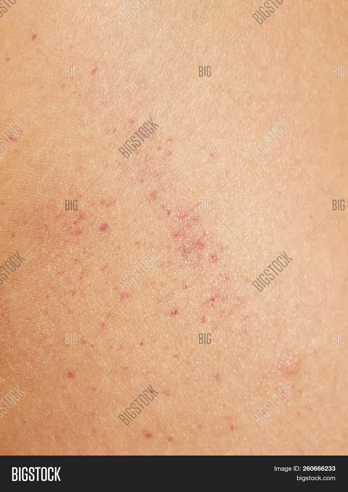 Unhealthy Human Skin Image & Photo (Free Trial) | Bigstock