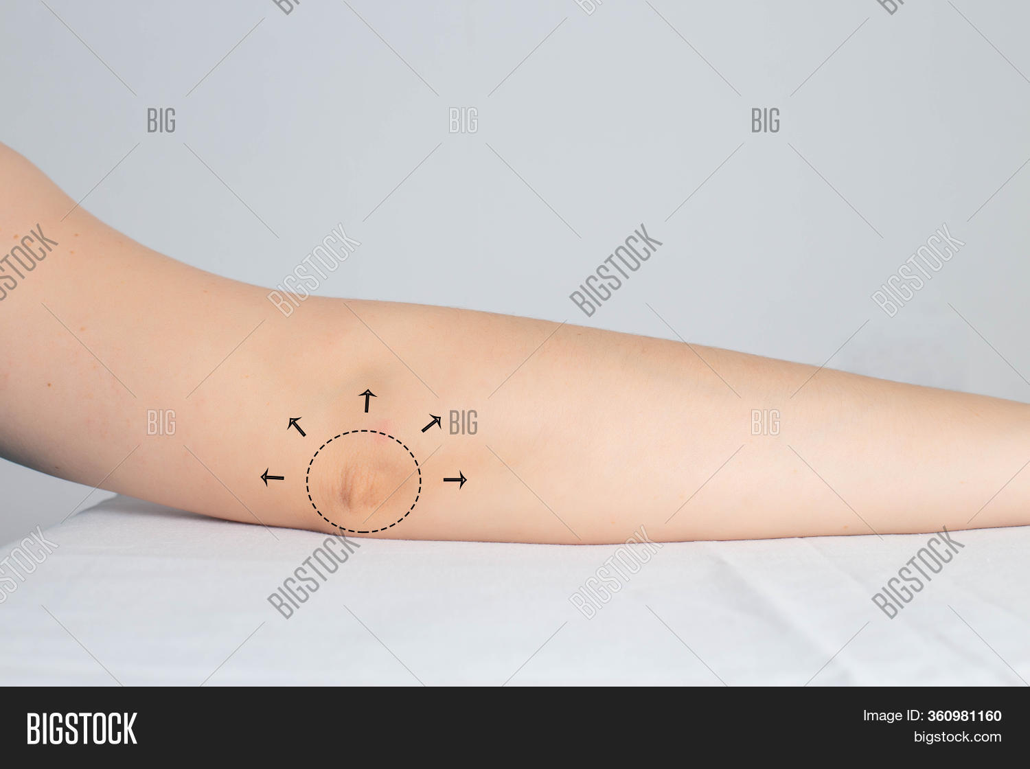 Markers On Elbow Image & Photo (Free Trial) | Bigstock
