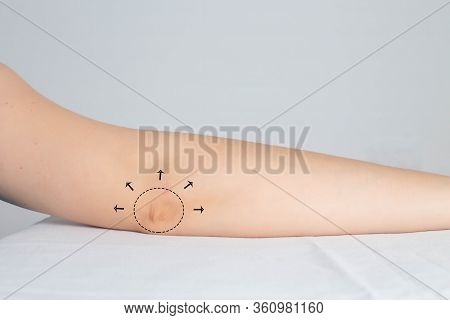 Markers On Elbow Image & Photo (Free Trial) | Bigstock
