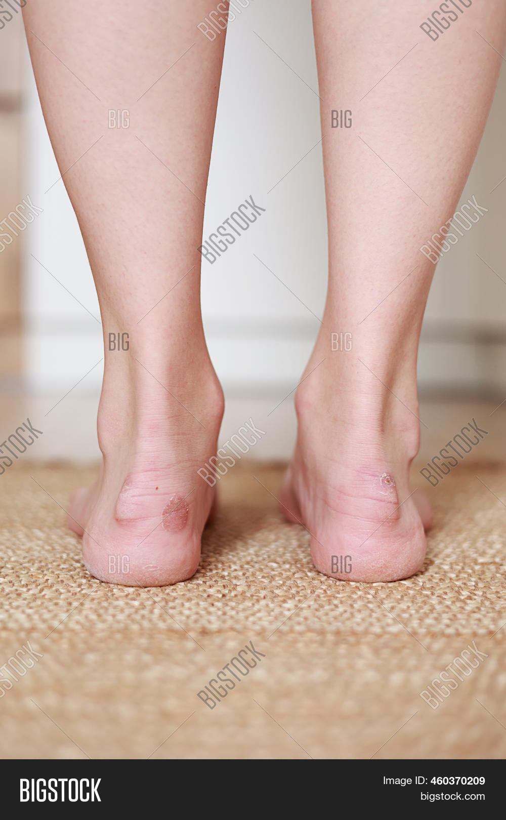 Callus Blisters On Image & Photo (Free Trial) | Bigstock