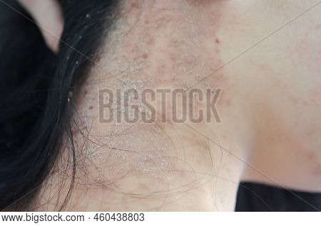 Skin Rashes On Neck Image & Photo (Free Trial) | Bigstock