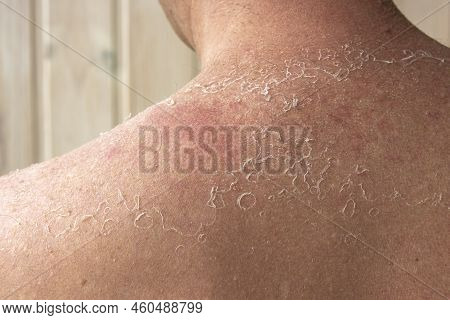 Skin Peels Off Pieces Image & Photo (Free Trial) | Bigstock