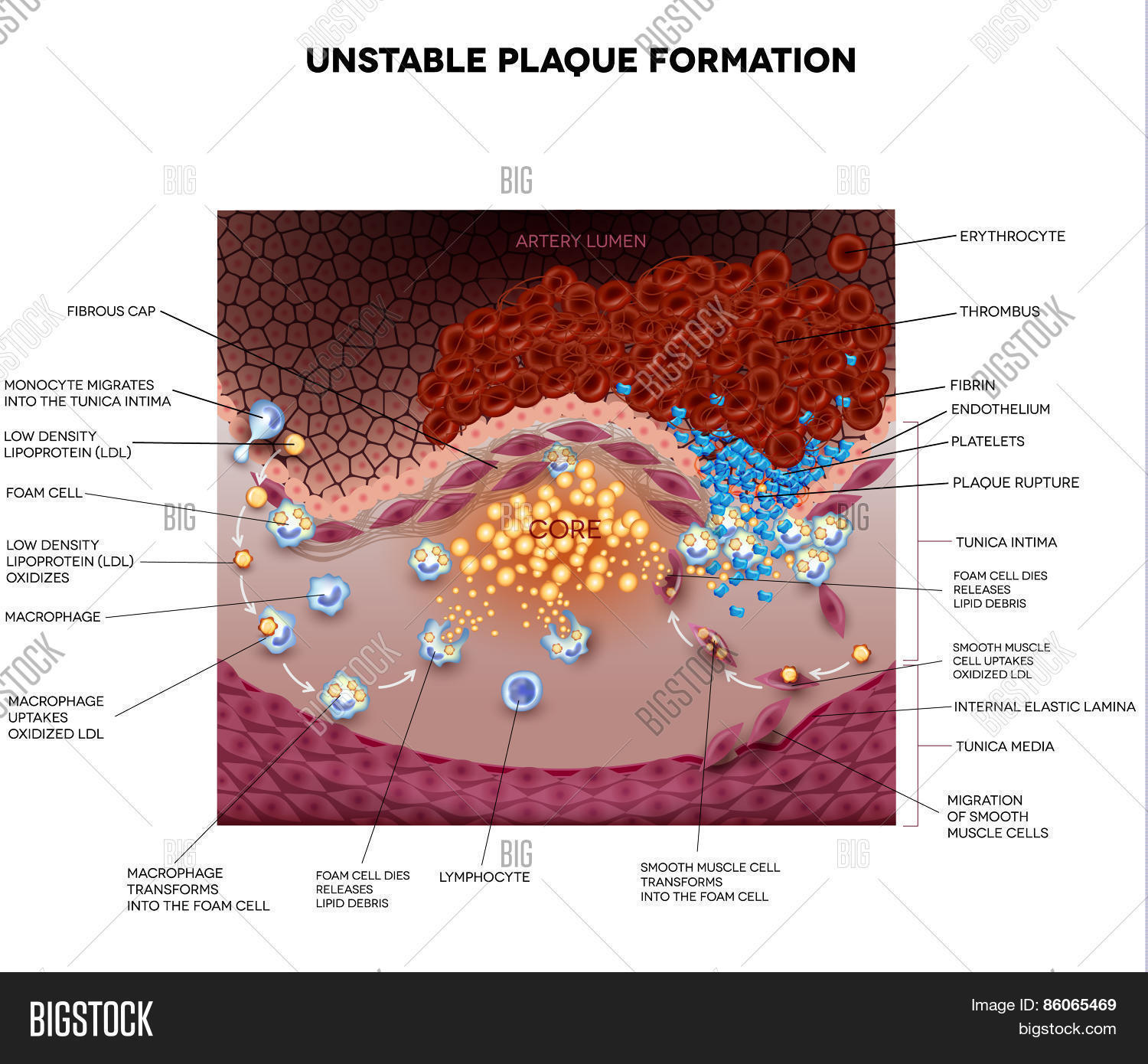 Thrombus, Blood Clot Vector & Photo (Free Trial) | Bigstock