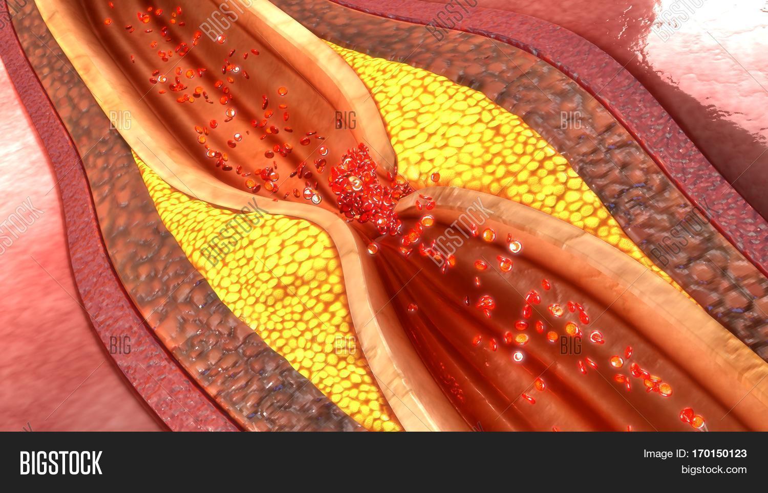 Thrombolytic Therapy Image & Photo (Free Trial) | Bigstock