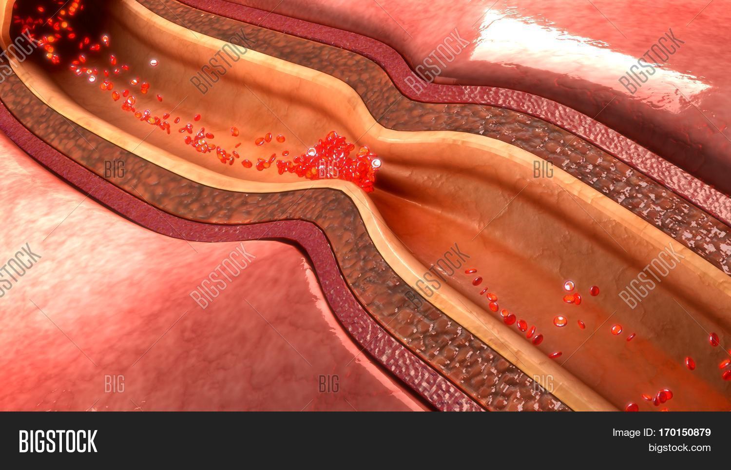Coronary Artery Spasm Image & Photo (Free Trial) | Bigstock
