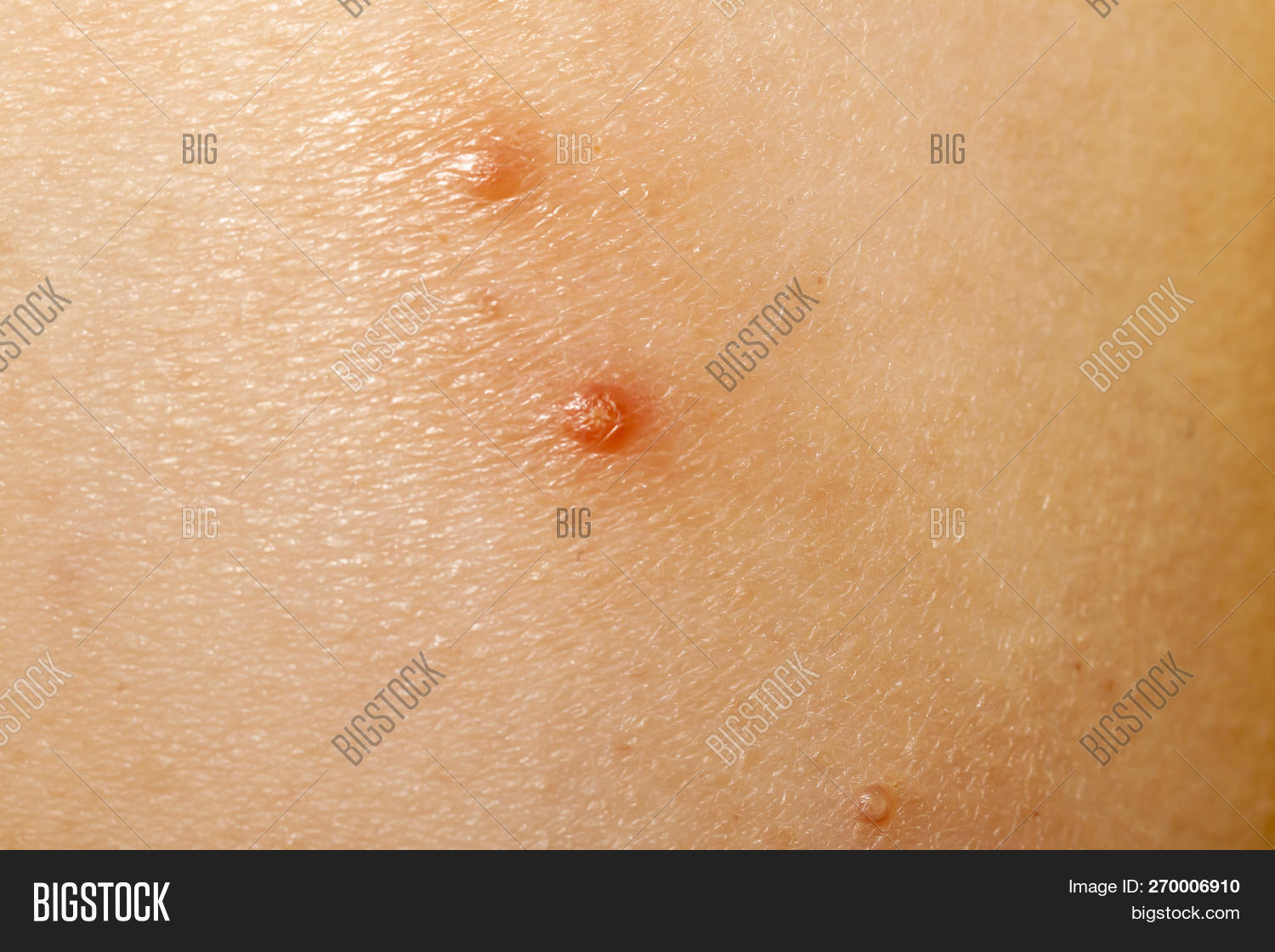 Close Molluscum Image & Photo (Free Trial) | Bigstock