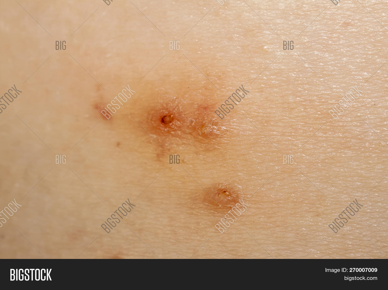 Close Molluscum Image & Photo (Free Trial) | Bigstock