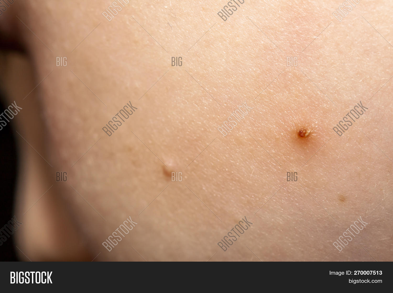Close Molluscum Image & Photo (Free Trial) | Bigstock