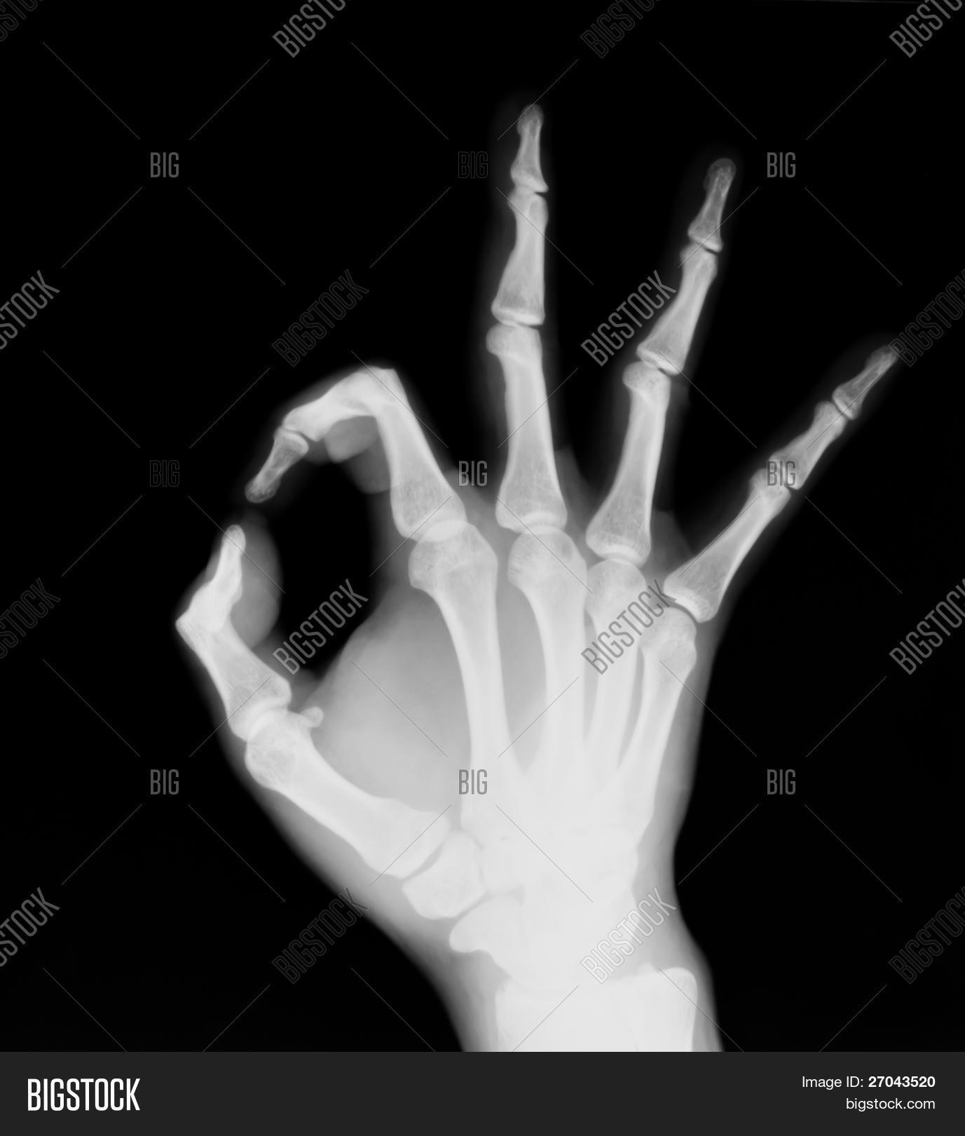 X-ray Both Human Hand Image & Photo (Free Trial) | Bigstock