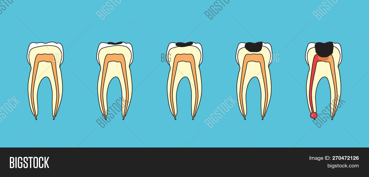 Destruction Tooth Image & Photo (Free Trial) | Bigstock