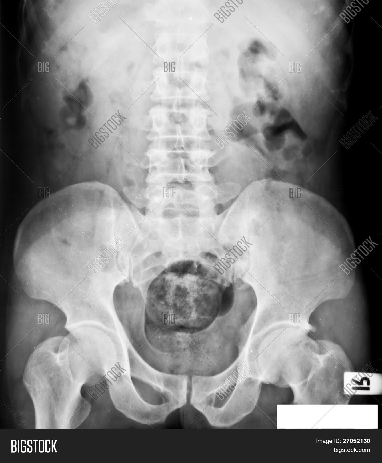 X-ray Pelvis Spinal Image & Photo (Free Trial) | Bigstock