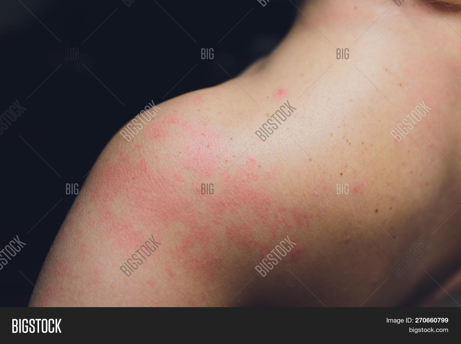 Close Allergy Rash, Image & Photo (Free Trial) | Bigstock