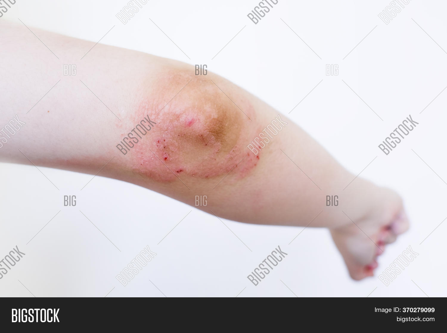 Atopic Dermatitis On Image & Photo (Free Trial) | Bigstock